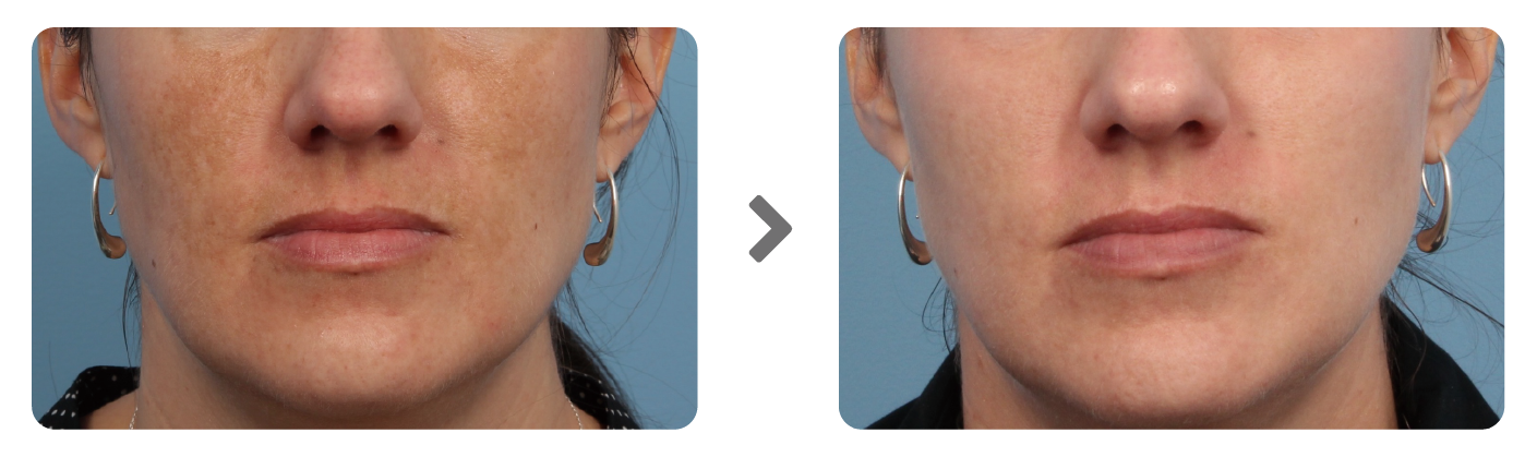 2025打斑去斑首選：Hollywood Spectra Laser Light（荷里活激光）